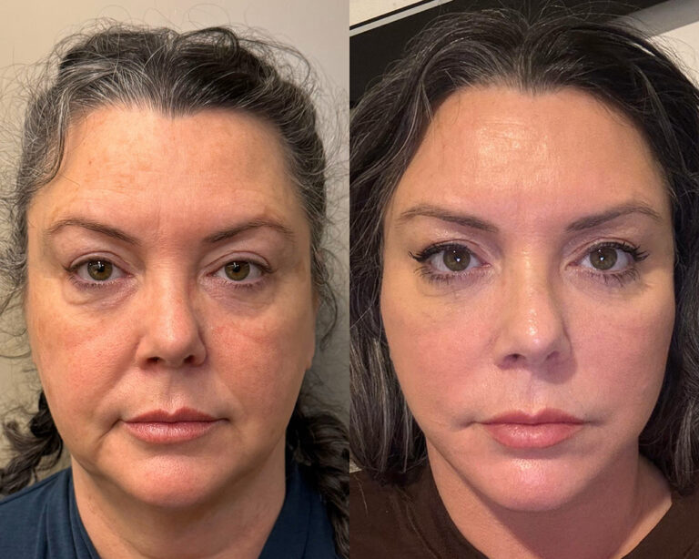 Face Lift - Health in Turkey